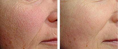 Skin Tone & Texture Procedures