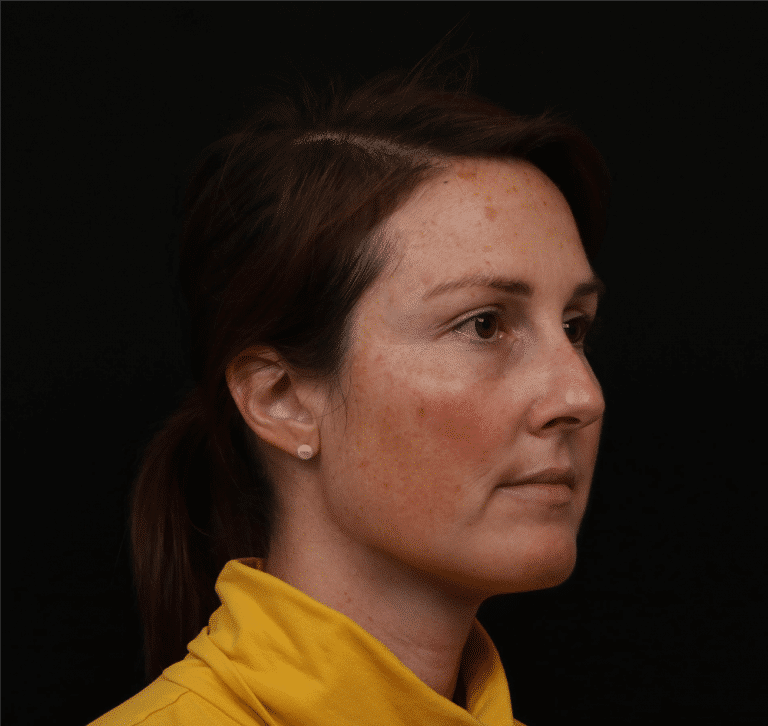 Skin Sun Spots and Damage Treatment