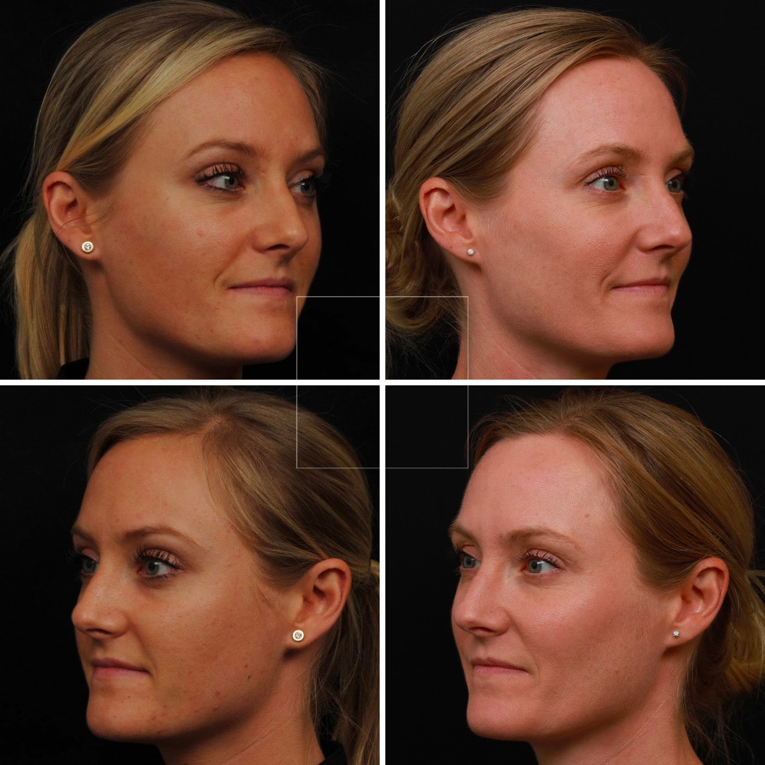 Skin Rejuvenation Treatments: How Long do Results Last?